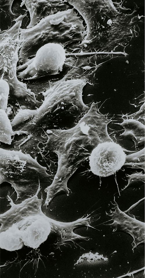 Qué es CRIS | Fundación CRIS Contra el Cáncer